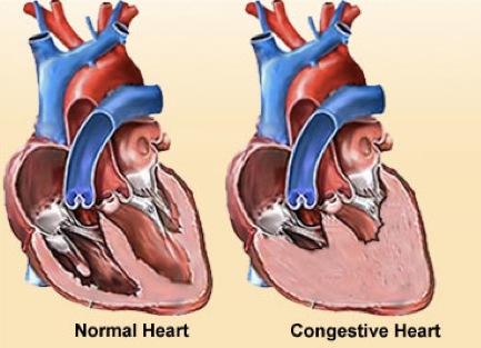 Congestive Heart Failure - The Real Facts and What You Need To Know
